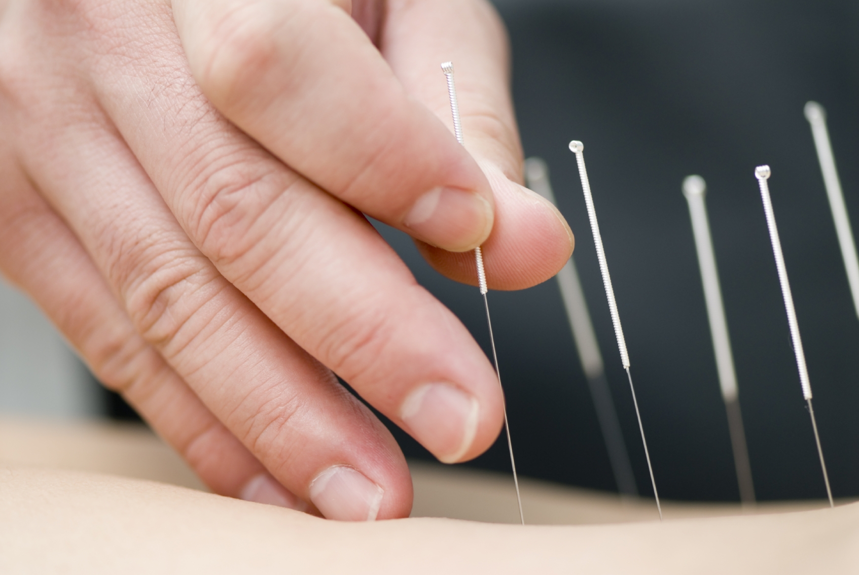 Dry Needling | JM Physical Therapy